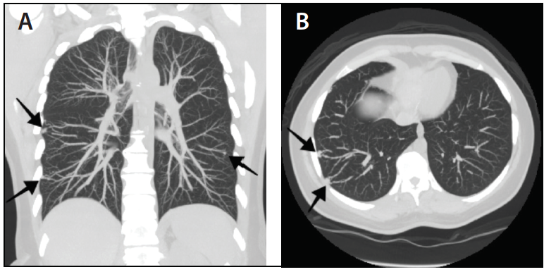 Use of the MVP™ Micro Vascular Plug System as a Single Occlusion Device ...
