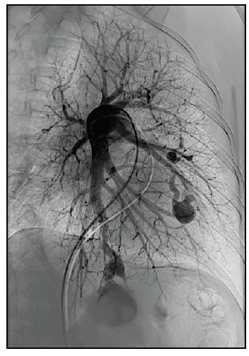 Use of the MVP™ Micro Vascular Plug System as a Single Occlusion Device ...