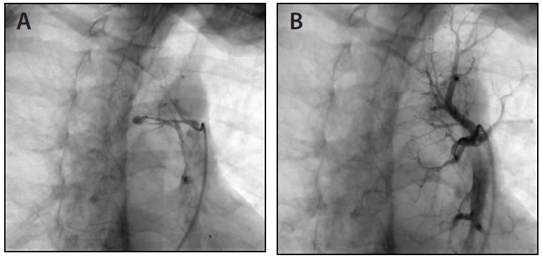 Use of the MVP™ Micro Vascular Plug System as a Single Occlusion Device ...