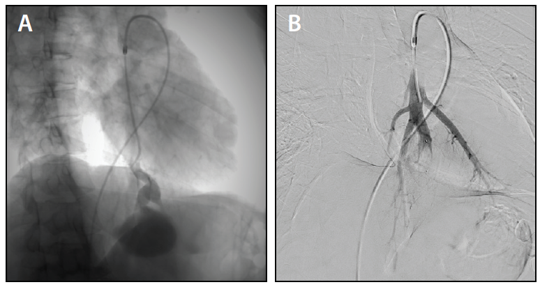 Use of the MVP™ Micro Vascular Plug System as a Single Occlusion Device ...