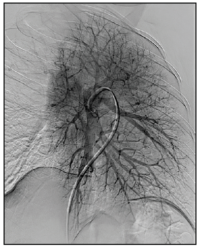 Use of the MVP™ Micro Vascular Plug System as a Single Occlusion Device ...