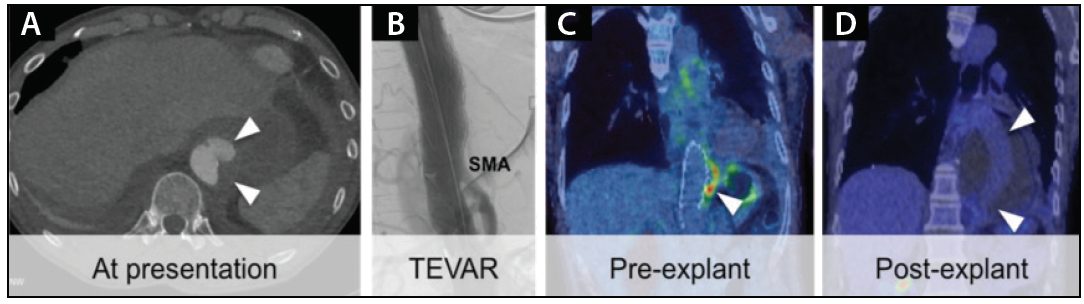 Managing Infected Thoracic Endografts - Endovascular Today
