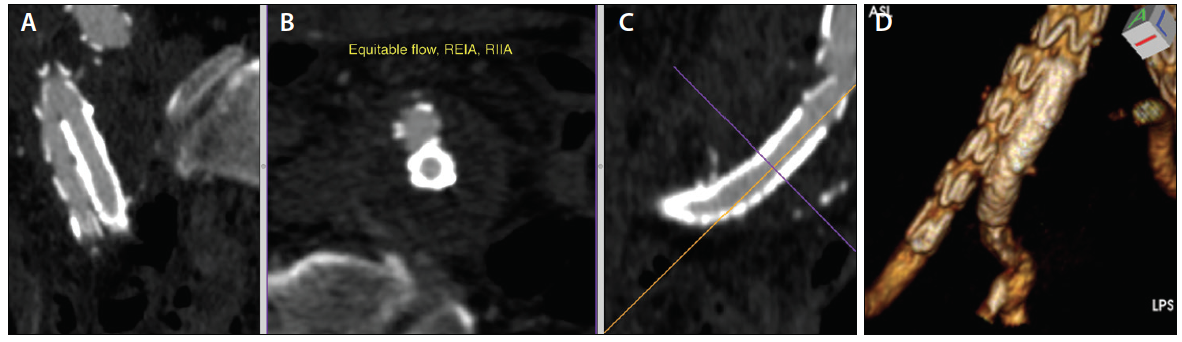 The Advantages of Customized Vascular Implants for Challenging Aortic ...