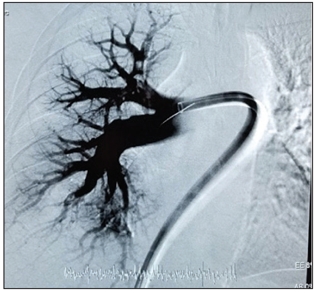 Novel Mechanical Thrombectomy Tools for Venous Thromboembolism ...