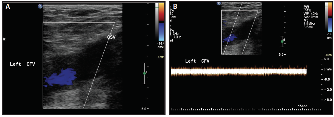 Identifying the Right Diagnosis at the Right Time - Endovascular Today