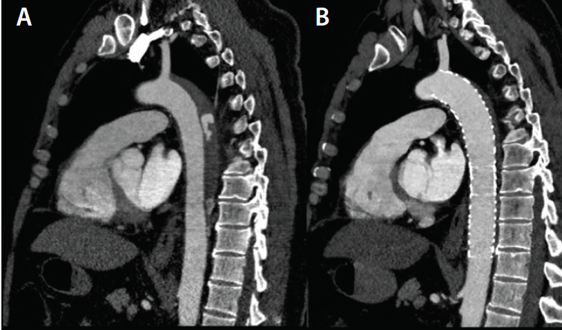 Differential Diagnosis of Aortic Pathologies - Endovascular Today