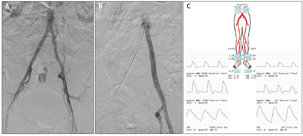 Iliac Intervention and Management of the Challenging Bifurcation and ...