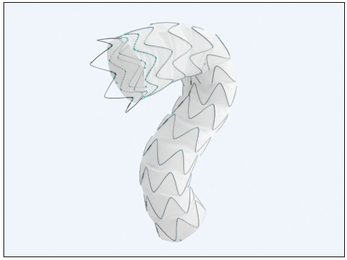 The Valiant Navion™ Thoracic Stent Graft System: Created to Tackle ...