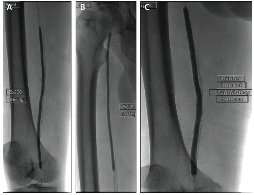 Long Balloons in Practice: Improving Our Treatment Options ...