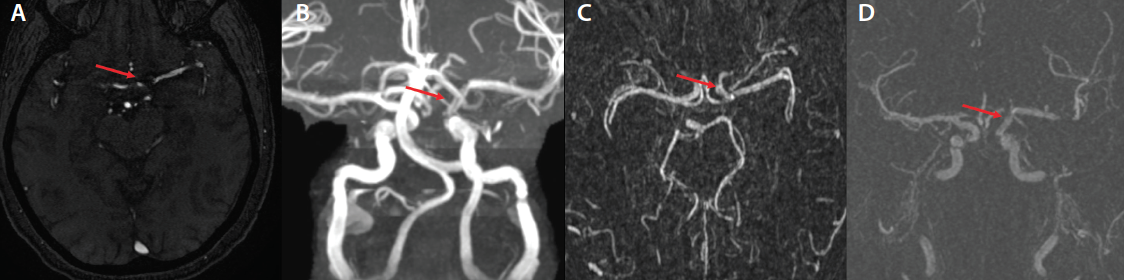 Cerebral Aneurysm Follow-Up: How Standards Have Changed and Why ...