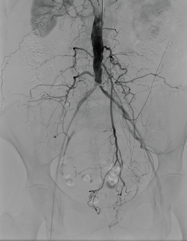 Current Challenges for the Modern Management of PAD - Endovascular Today