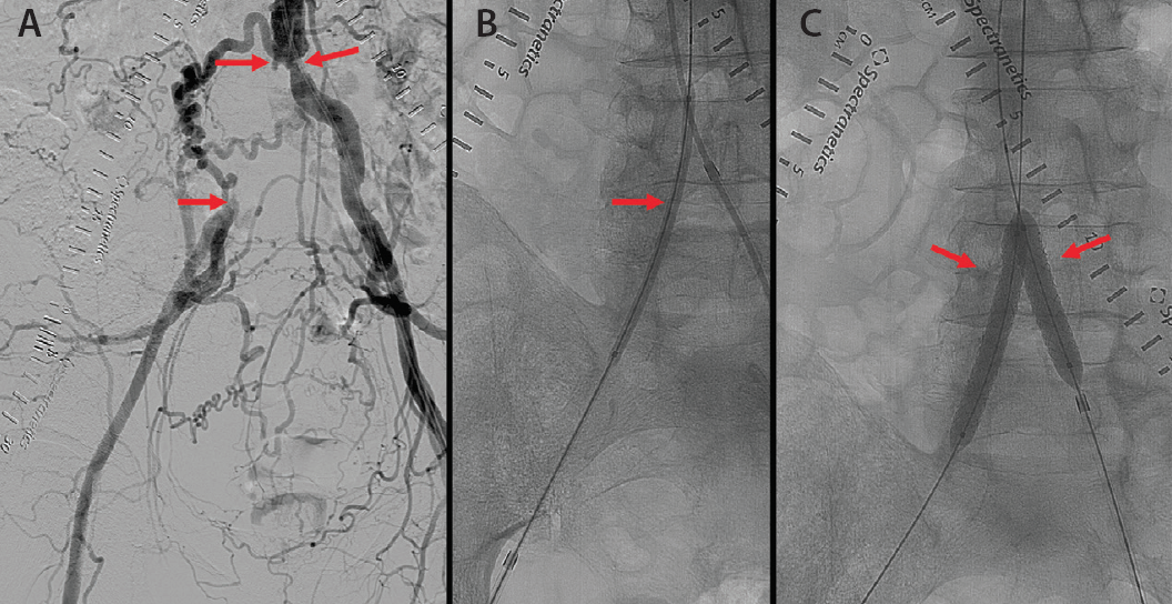 Case Report: Aortoiliac Occlusion in a Patient With Severe Claudication ...