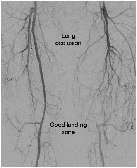 Case Report: Retrograde Laser Crossing of a Left SFA Occlusion With an ...