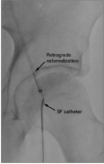 Case Report: Retrograde Laser Crossing of a Left SFA Occlusion With an ...
