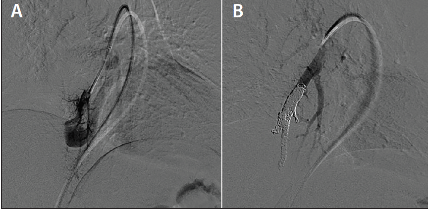 Ruby, POD, and POD Packing Coil: Dedicated Devices for Different ...
