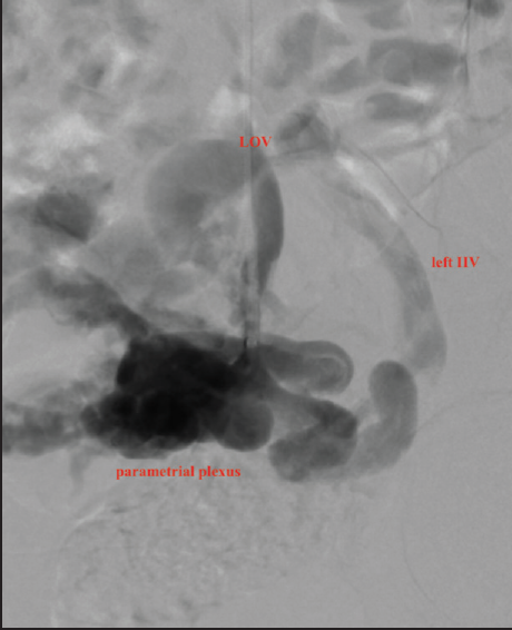 Ruby, POD, and POD Packing Coil: Dedicated Devices for Different ...