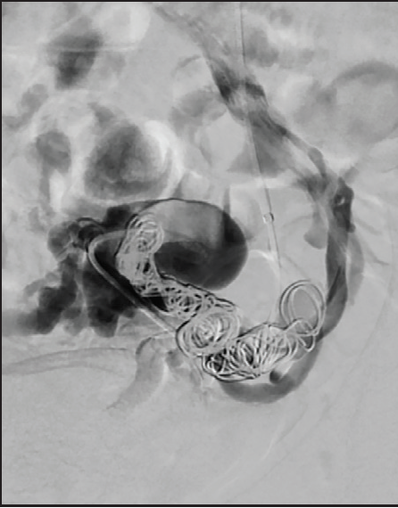 Ruby, POD, and POD Packing Coil: Dedicated Devices for Different ...