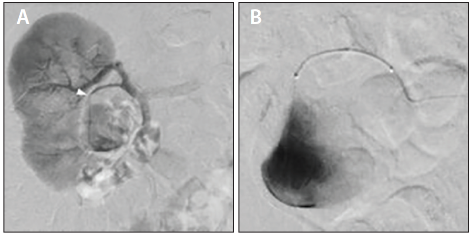 Ruby, POD, and POD Packing Coil: Dedicated Devices for Different ...