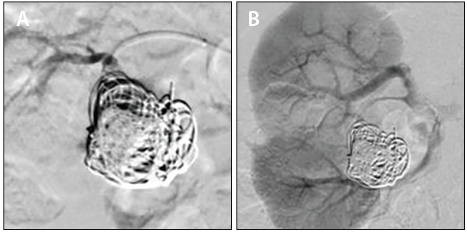 Ruby, POD, and POD Packing Coil: Dedicated Devices for Different ...