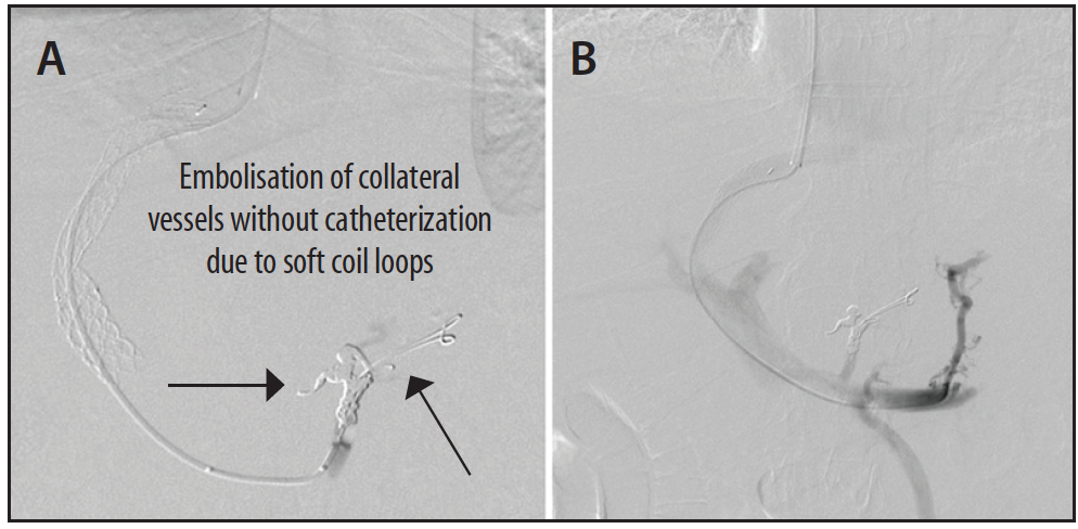Ruby, POD, and POD Packing Coil: Dedicated Devices for Different ...