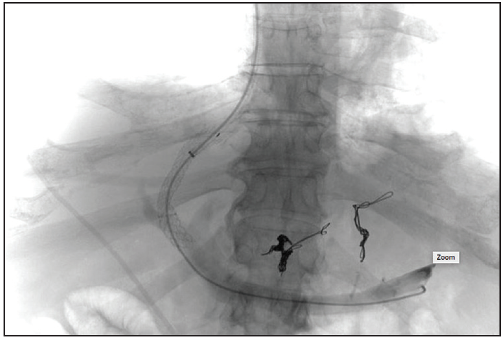 Ruby, POD, and POD Packing Coil: Dedicated Devices for Different ...