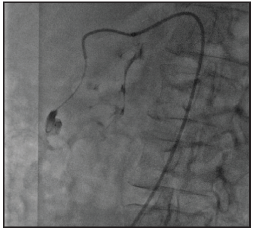 Ruby, POD, and POD Packing Coil: Dedicated Devices for Different ...