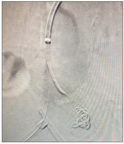 Ruby, POD, Packing Coil, and LANTERN: A Complete Embolization Platform ...