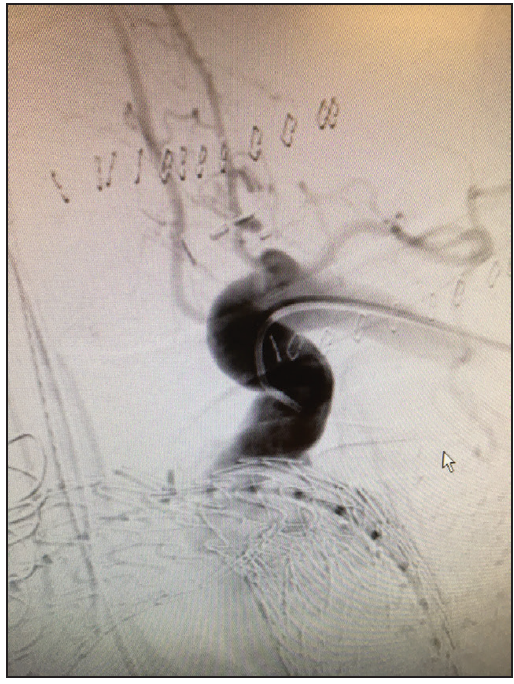 Ruby, POD, Packing Coil, and LANTERN: A Complete Embolization Platform ...