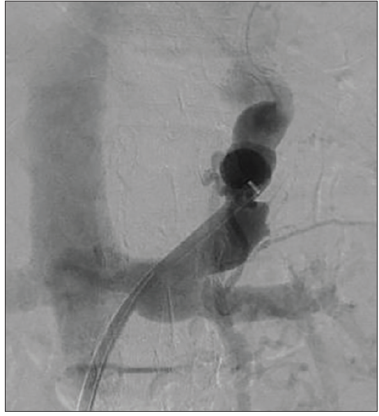 Ruby, POD, Packing Coil, and LANTERN: A Complete Embolization Platform ...