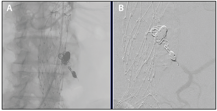 Case Report Embolization Of Transarterial Type Ii Endoleak Using