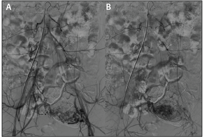 Case Report: Embozene™ Microspheres for Uterine AVM Embolization ...