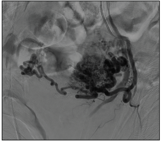 Case Report: Embozene™ Microspheres for Uterine AVM Embolization ...