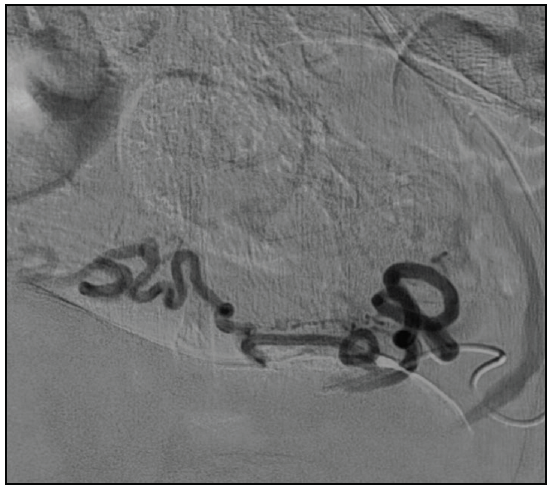 Case Report: Embozene™ Microspheres for Uterine AVM Embolization ...