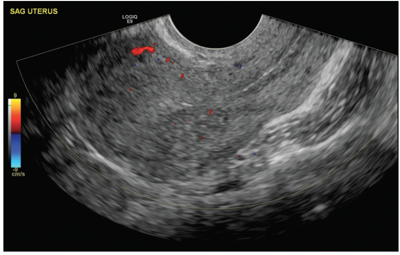 Case Report: Embozene™ Microspheres for Uterine AVM Embolization ...