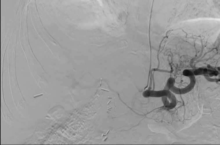 Case Report: Metastatic Neuroendocrine Tumor Using Direxion ...