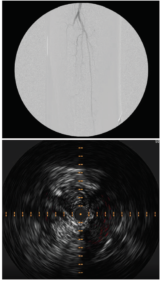 Case Report: Successful Recanalization of a Totally Occluded Anterior ...