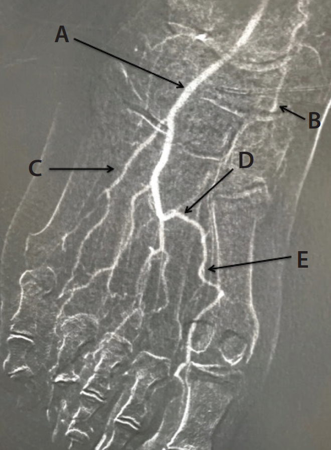 Techniques for Successful BTK Revascularization - Endovascular Today