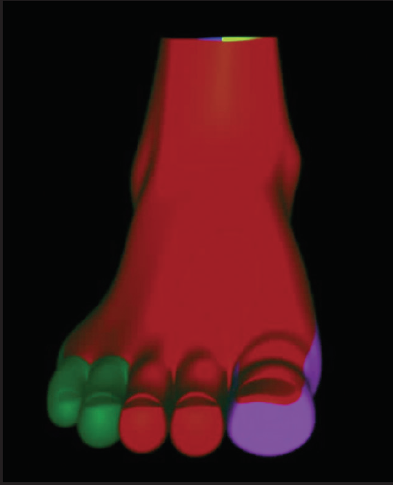 Techniques for Successful BTK Revascularization - Endovascular Today