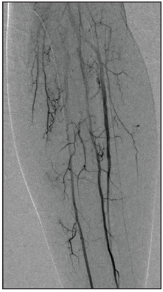 Case Report: Utilizing IVUS Below-the-Knee - Endovascular Today