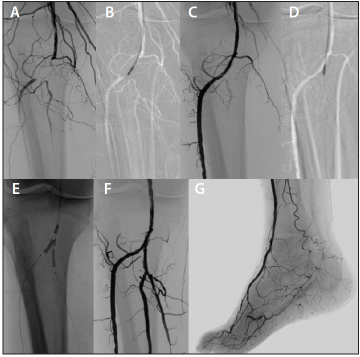 Case Reports: Use of Atherectomy + DCB in CLI - Endovascular Today