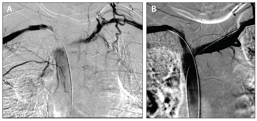 Evaluation and Management of Chronic Thoracic Venous Obstructions ...