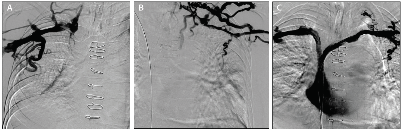 Evaluation and Management of Chronic Thoracic Venous Obstructions ...