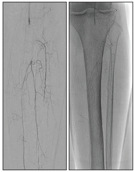Mechanical Power Aspiration With the Indigo® System: Rethinking Clot ...