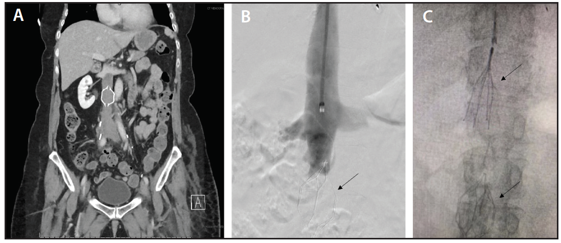 Treating Common but Complex VTE Scenarios - Endovascular Today