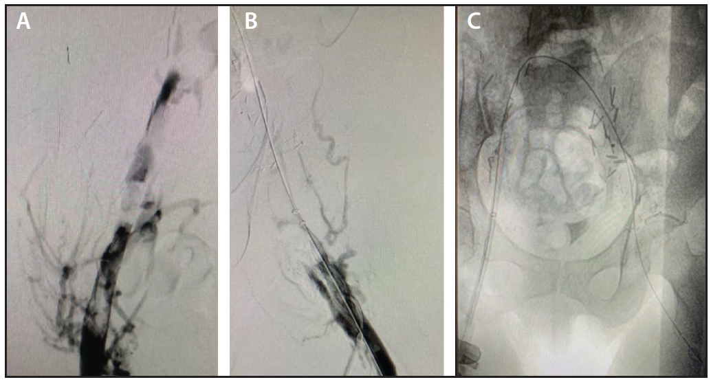Treating Common but Complex VTE Scenarios - Endovascular Today