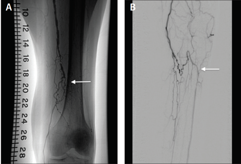Mixed Ulceration From Arterial and Venous Insufficiency: Is There an ...