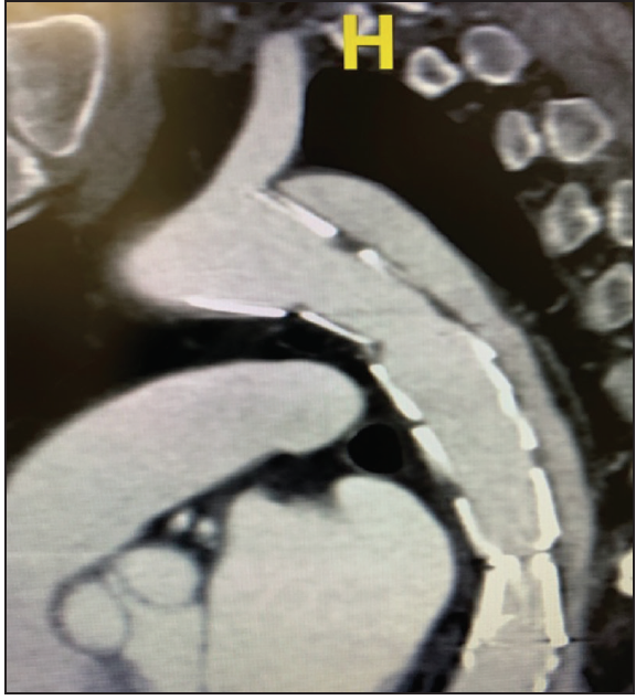 Residual Type B Aortic Dissection With Worsening Renal Malperfusion ...