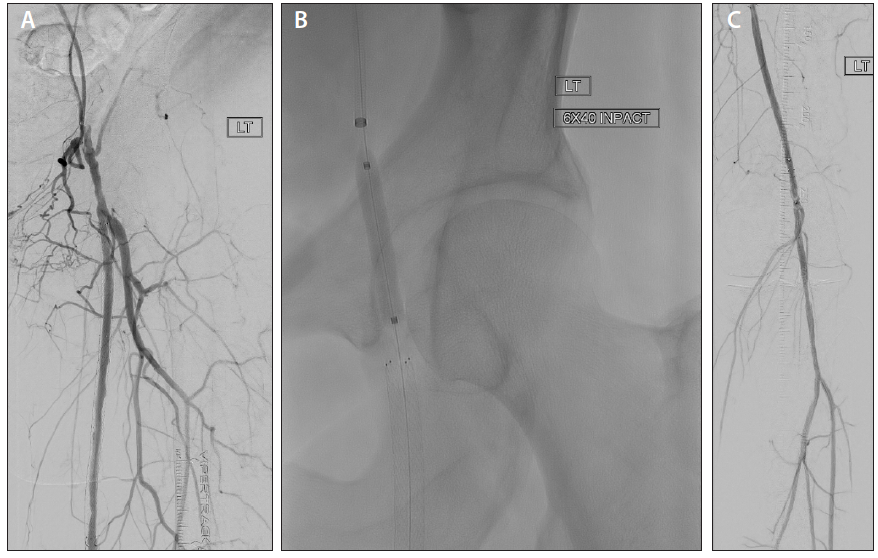 The Curse of the Long SFA Occlusion - Endovascular Today