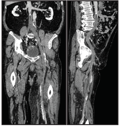 Filter-Associated DVT in an Elderly Patient - Endovascular Today