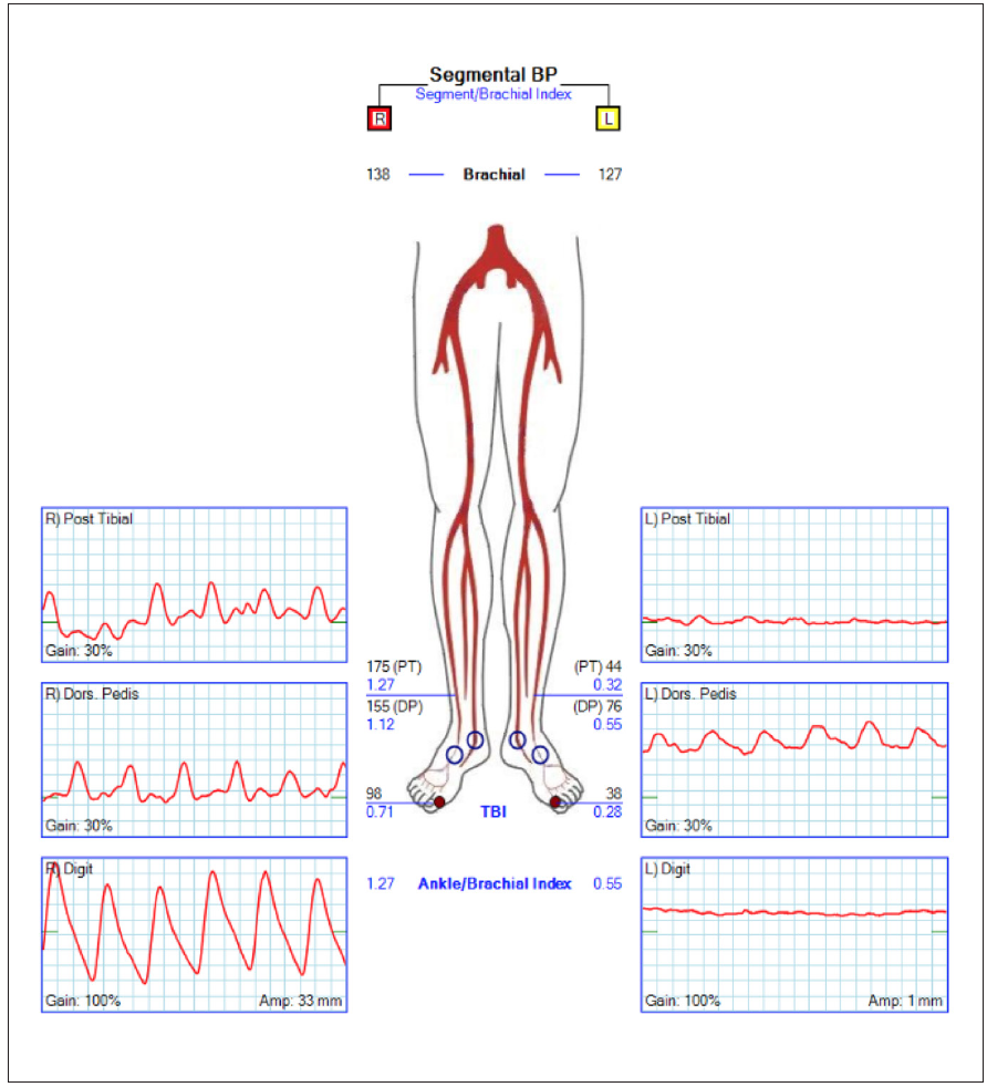 Multiple Lower Limb Occlusions and Vascular Anomaly - Endovascular Today